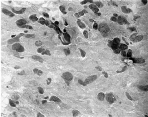 Biopsy Of The Conus Medullaris Mass Reveals Moderate Hypercellularity
