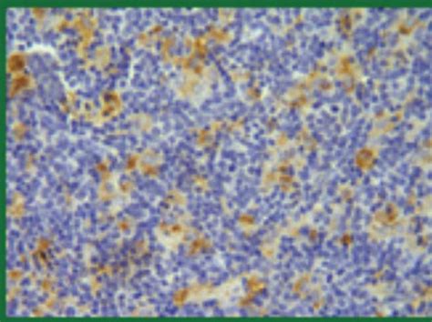 Dlbcl With Reactive Appearing Histocytes In The Background A C ×200