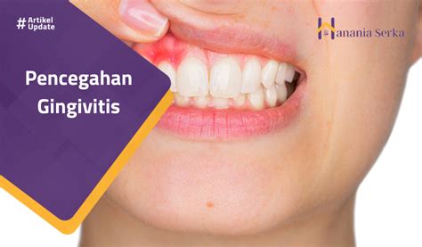 Pencegahan Gingivitis Hanania Serka