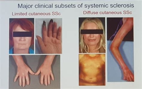 Skleroderma Dan Lupus Apakah Sama Dokter Rematik Autoimun