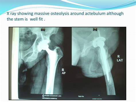 Ppt Case Presentation Thr Bl Tkr And Lcp Fixation Powerpoint