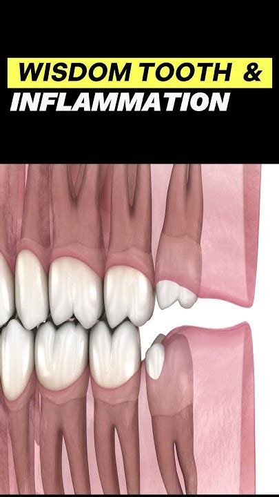 Why Wisdom Tooth Gums Inflamed Youtube