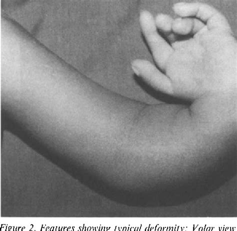 Figure 2 From Radial Club Hand With A Short Hypoplastic Radius Treated Surgically Semantic Scholar