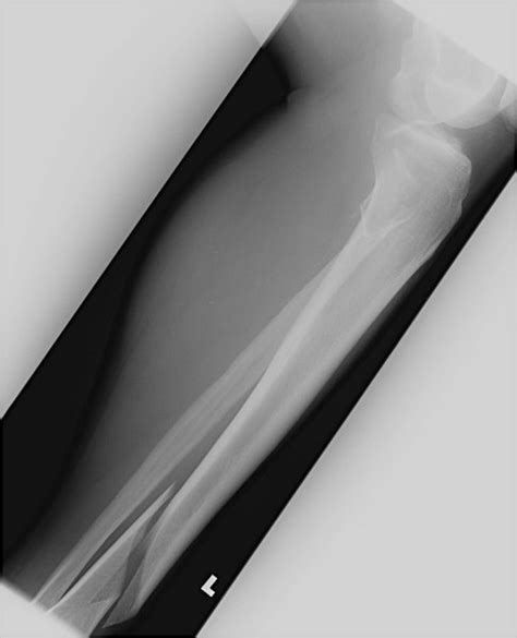Musculoskeletal Radiology Of Fractures