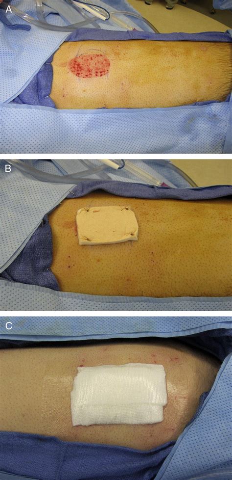 An Alternative Coverage For Split Thickness Skin Graft Donor Site