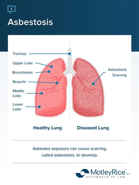 Asbestos Lung Cancer How Long Does It Take Asbestos Lung Cancer To