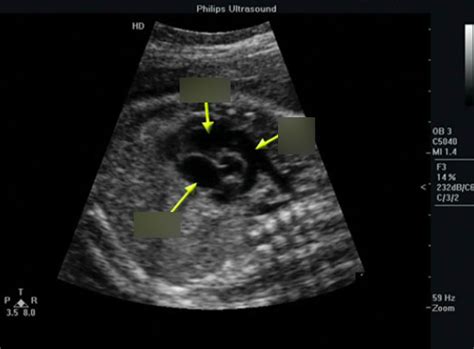 Rvot Heart View Diagram Quizlet