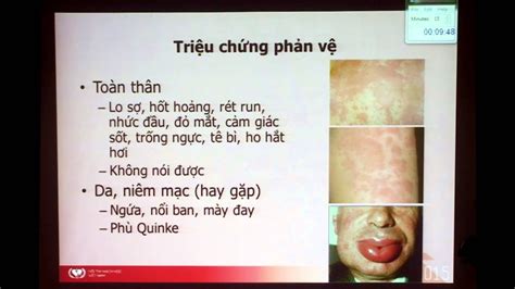 Tìm Hiểu Về Phản Vệ Và Sốc Phản Vệ Và Cách Phòng Ngừa