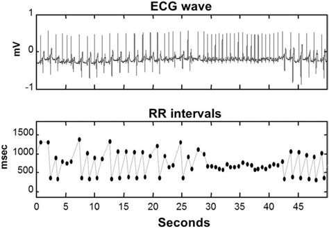 An Ecg Recording Upper And Derived Heartbeat Intervals Lower Of A Download Scientific