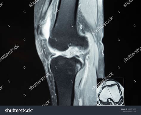 Anatomy Mri Knee At Guadalupe Wolf Blog
