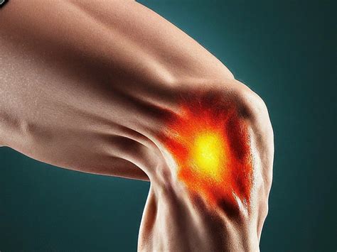 Understanding Patellar Tendonitis Causes Symptoms And Management Miss Ella Mcaleese