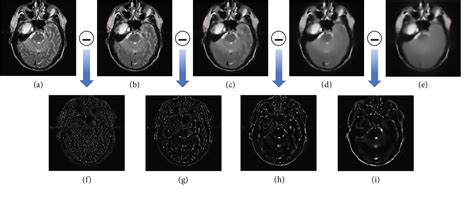 figure 1 from multimodal brain image fusion based on improved rolling