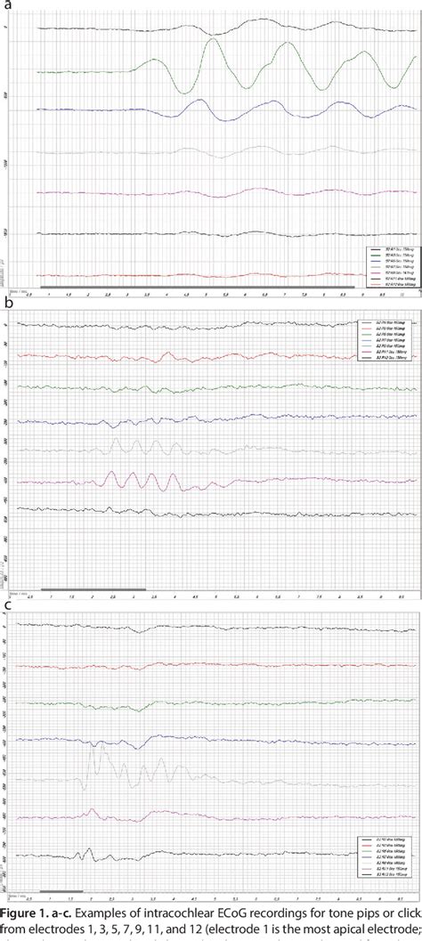 Figure 1 From Cochlear Microphonics In Hearing Preservation Cochlear Implantees Semantic Scholar