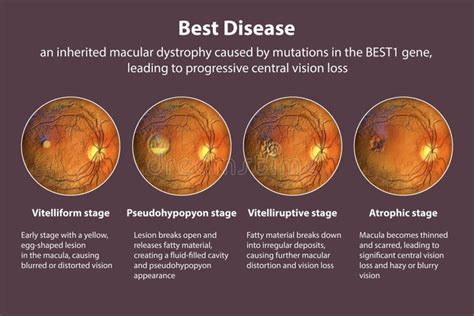 Dystrophy Stages Stock Illustrations 10 Dystrophy Stages Stock