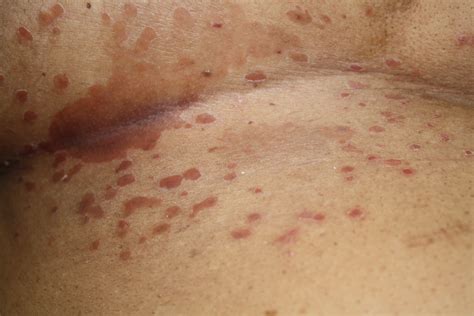 Candidiasis Skin Folds