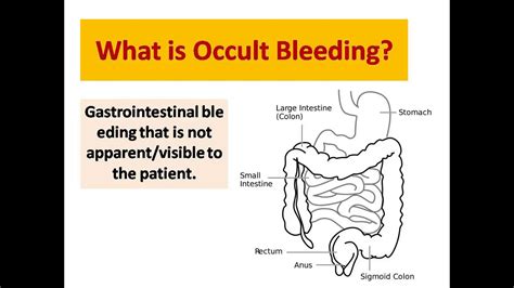 How To Approach Occult Gastrointestinal Bleeding What Is Fecal