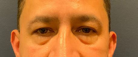 Eyelid Surgery Case Brown Md