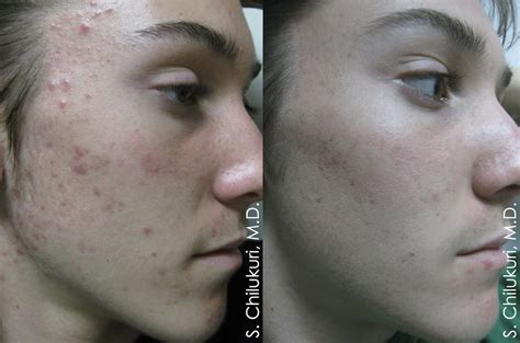 Acne Treatment Archives Refresh Dermatology