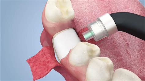 Smartact Evo Youtube