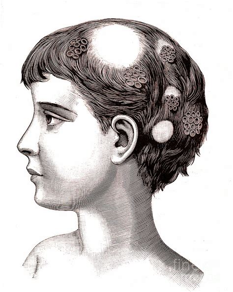 Ringworm Photograph By Science Photo Library Pixels