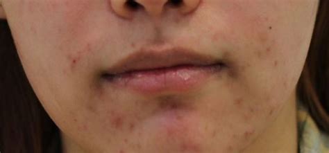 Acne Around Mouth Or Chin Causes And Treatments Skincarederm