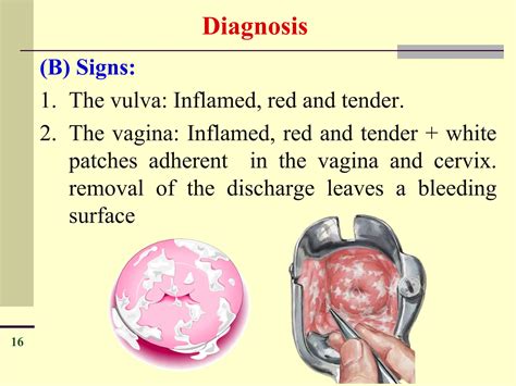9 Sexual Transmitted Disease Modifiedpptx Sexual Conditions
