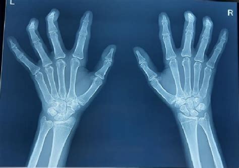X Ray Bilateral Hand Anteroposterior View Demonstrating The Fixed Download Scientific Diagram