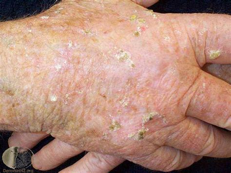 Actinic Keratosis Treatment Colorado Springs And Monument