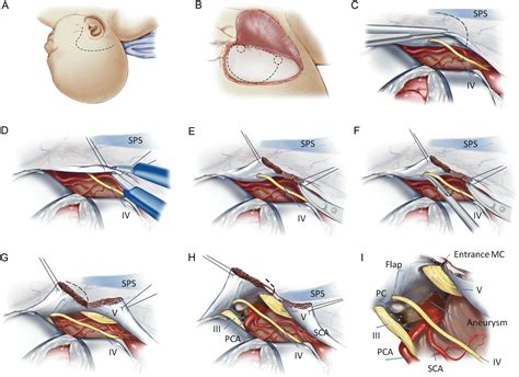 Extended Subtemporal Transtentorial Approach To The Anterior Incisural