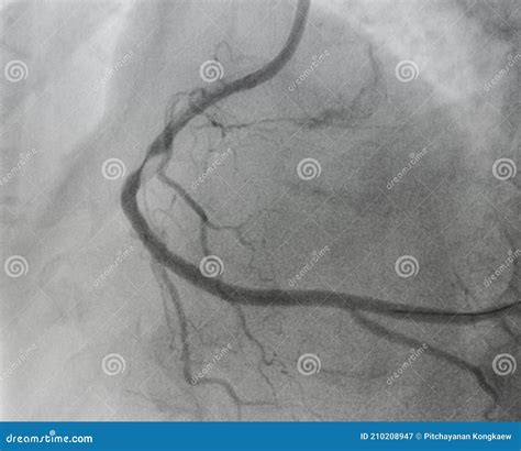 Coronary Angiogram Stock Image 244331287