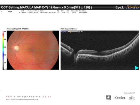 Glaucoma And Oct Are Macula Scans More Valuable Than Disc Scans Pptx