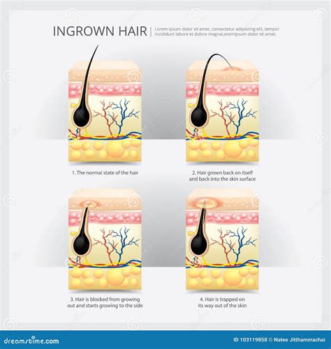 Ingrown Hair Structure Stock Vector Illustration Of Cosmetic 103119858
