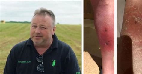 벌레 살짝 물렸을 뿐인데… 다리 절단 위험 처했던 50대 남성 사연 보니