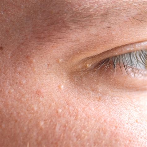 Milien Grießkörner Ursachen And Wirksame Schnelle Behandlung