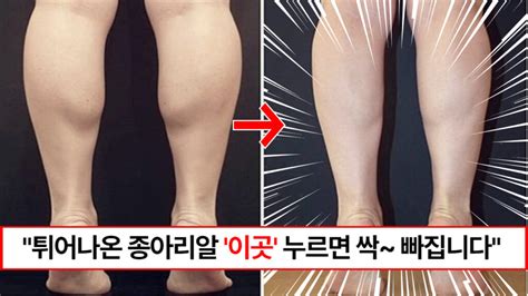 “종아리 알이 사라졌어요” 종아리 부종 근육뭉침 혈액순환 혈자리 자극하여 알 빼는 방법 뉴스위크