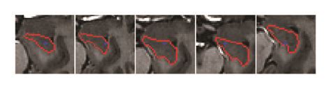 Segmentation Of Hippocampus With Different Initial Seed Points A