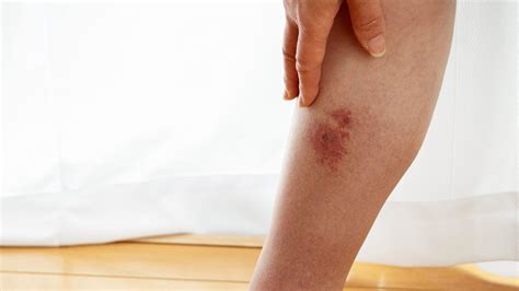Cellulitis Knee