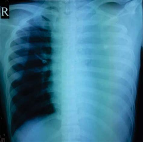 Figure 1 From Pulmonary Amebiasis Complicated With Massive Left Empyema