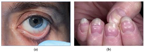 Anemic Eyelids