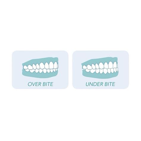 Dr 😬 Overbite Vs Underbite What Can You Do About It 🦷 Whats The Difference 🔹 Overbite