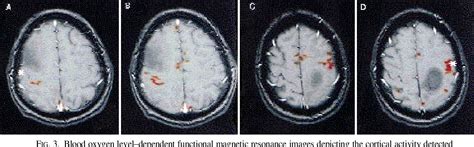 Figure 1 From Presurgical Identification Of The Primary Sensorimotor