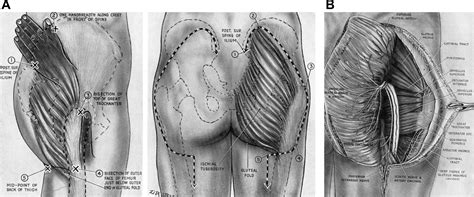Massive Aneurysm In A Persistent Sciatic Artery Annals Of Vascular Surgery