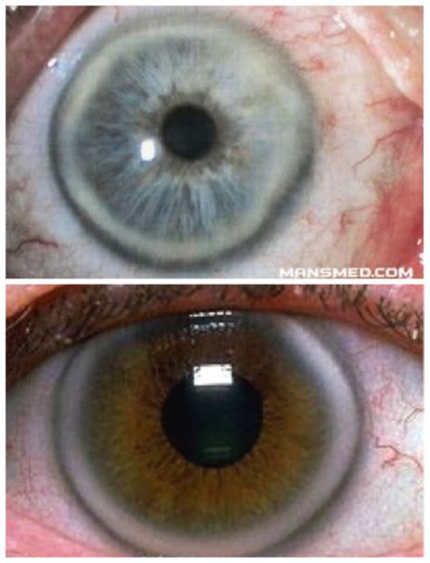 Brown Eyes With Blue Ring Around Iris