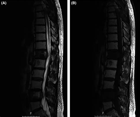 Mri After The First Radiation Cycle Sagittal T2 Sequence A And
