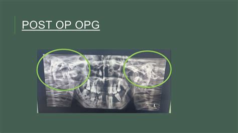 Condylar Dislocation Etiopathogenesis And Treatment Pptx