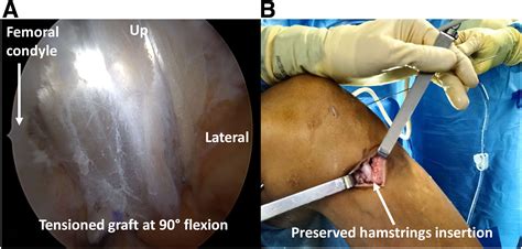 Posterior Cruciate Ligament Reconstruction Using A Trans Septal Approach With Preserved