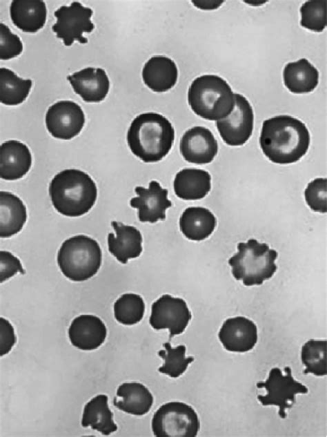10 Acanthocytes Copyright From Ahdcvet Download