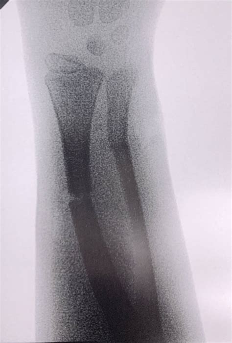 Forearm Synostosis Facts And My Approach To Treatment Congenital