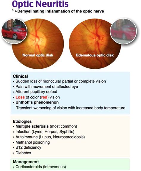 Optic Neuritis Signs Symptoms And Treatment Netzdot