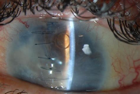 Left Eye Of A Patient Following Primary Closure And A Vitrectomy With Download Scientific